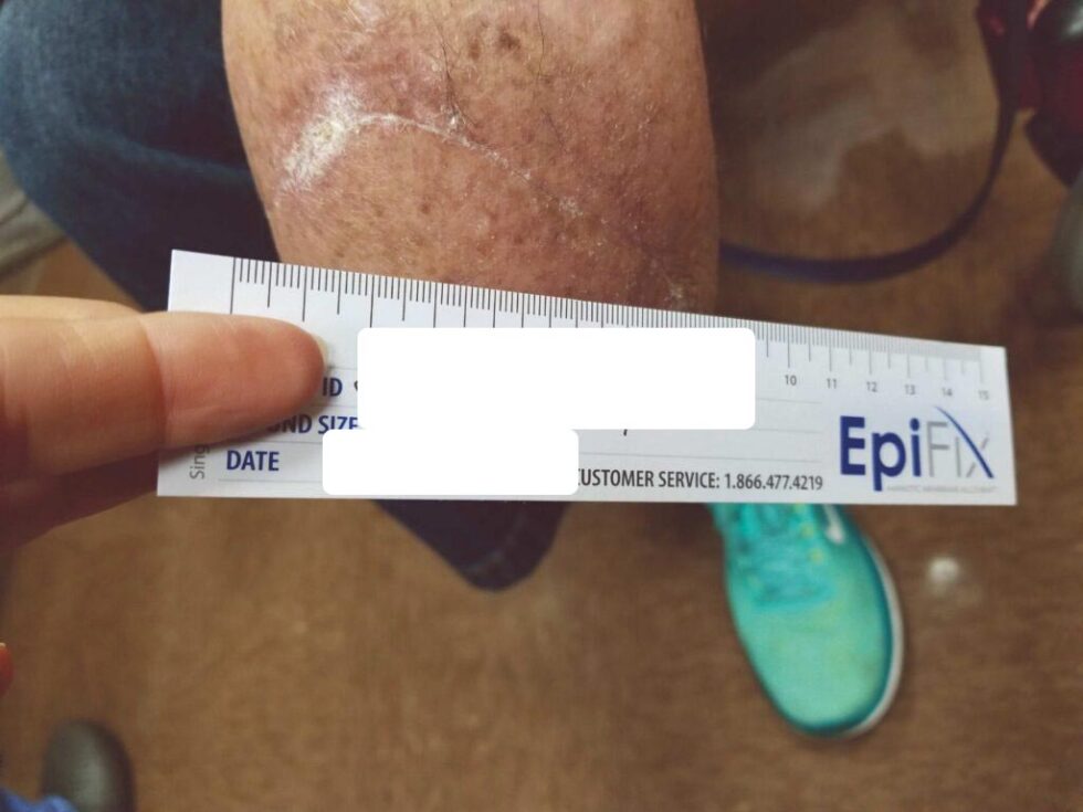 Foot & Ankle Surgery | MIMEDX