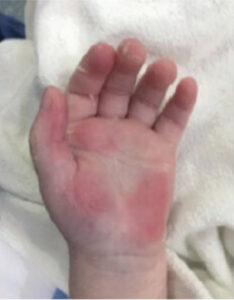 Burn and Trauma | MIMEDX